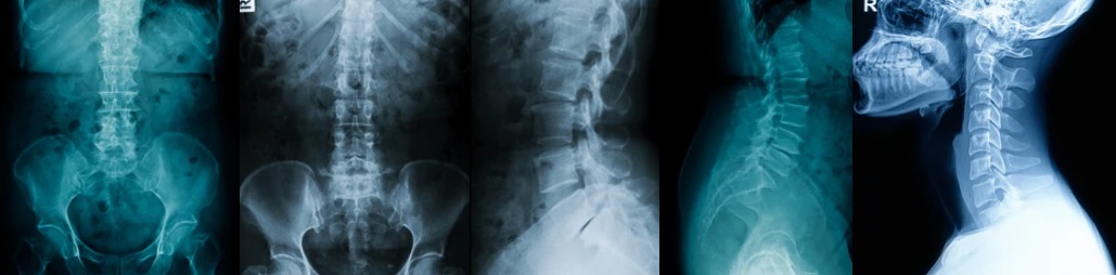 VinDr-SpineXR: An open dataset for spinal lesions detection and classification from radiographs ...