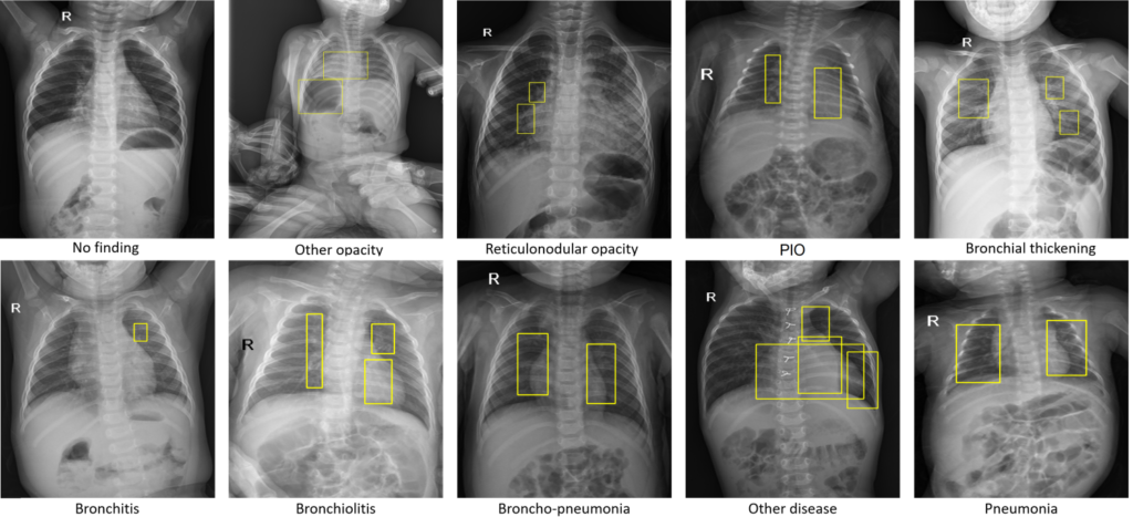 VinDr-SpineXR: An open dataset for spinal lesions detection and classification from radiographs ...