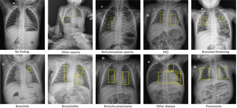VinDr-SpineXR: An open dataset for spinal lesions detection and ... VinDr-SpineXR: An open dataset for spinal lesions detection and ...